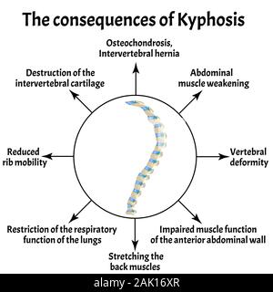 Causes of kyphosis. Spinal curvature, kyphosis, lordosis, scoliosis ...