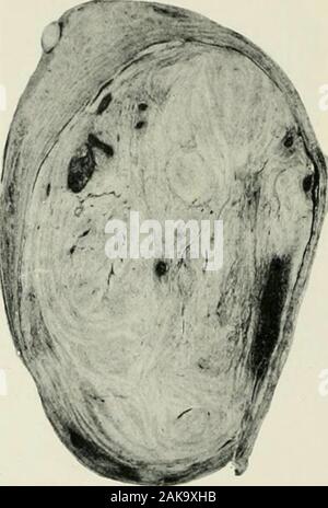 Gynecological diagnosis and pathology . VARY. The cystic ovary is ...