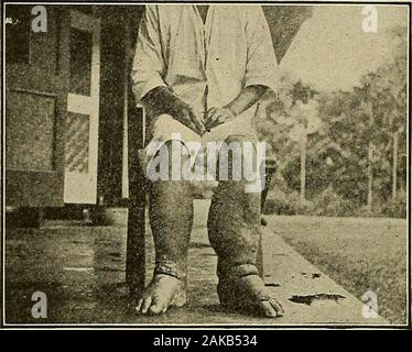 Tropical Diseases, Elephantiasis of legs Stock Photo - Alamy