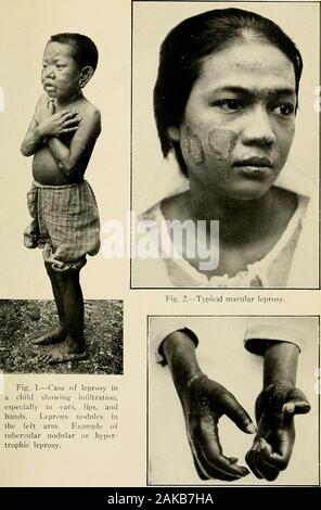 Leprosy Before And After Treatment