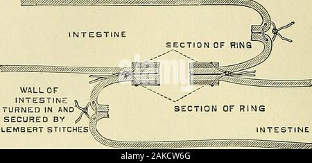 . Operative surgery, for students and practitioners . Lembert suturesof ...