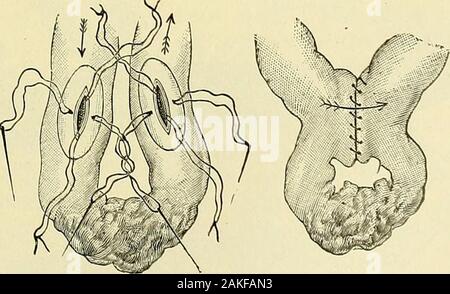 Operative surgery, for students and practitioners . c colon becomes ...