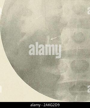 Pyelography (pyelo-ureterography) a study of the normal and pathologic ...