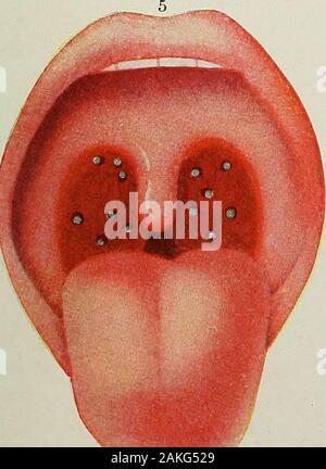 Pediatrics : the hygienic and medical treatment of children . Thrush ...