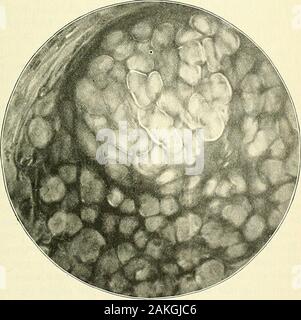 Molluscum contagiosum. Lesions on the skin of an adult male patient ...
