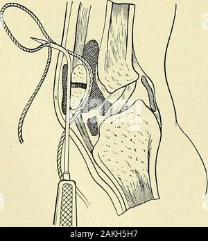 Operative surgery, for students and practitioners . ^ long to cover the ...