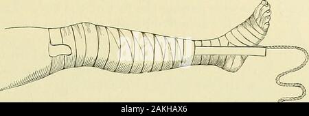 . Operative surgery, for students and practitioners . and this is to be ...