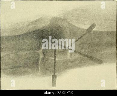 . A manual of operative surgery . Posterior posterior. FIG. 138 ...