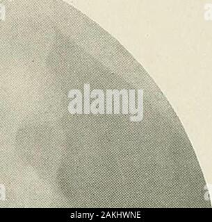 Pyelography (pyelo-ureterography) a study of the normal and pathologic ...