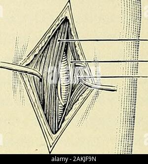 Operative surgery, for students and practitioners . or border of this ...