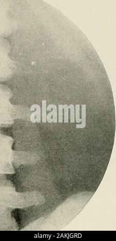 Pyelography (pyelo-ureterography) a study of the normal and pathologic ...