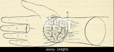 . Operative surgery. ^ The Oval or Racket Method.—The oval or ...