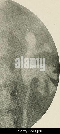 Pyelography (pyelo-ureterography) a study of the normal and pathologic ...