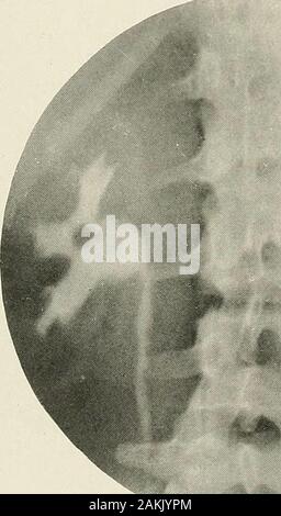 Pyelography (pyelo-ureterography) a study of the normal and pathologic ...