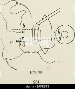 Atlas and epitome of operative ophthalmology . Fig. 133.—a ...