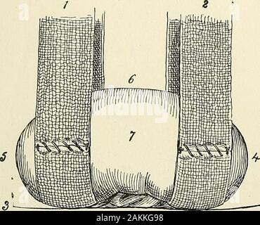 Modern surgery, general and operative . Ureter 1299 Gibsons incision ...