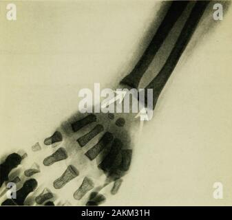 Scurvy past and present . Fig. IS.—Infant with marked scurvy ...