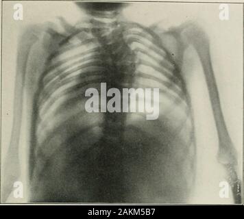 Congenital hip dislocation surgery. X-ray of the hip of a 15-month-old ...