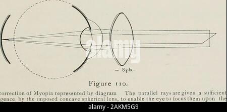 Ocular refraction and the shadow test . spherical lens; also comparison ...