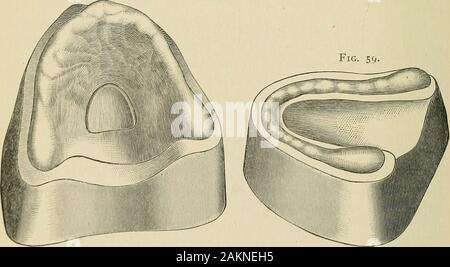 Dentures, partial dentures on plaster model Stock Photo - Alamy
