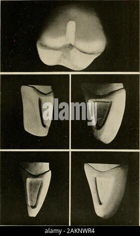 Principles and practice of operative dentistry . I. Simple Cavities ...
