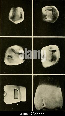 Principles and practice of operative dentistry . I. Simple Cavities ...