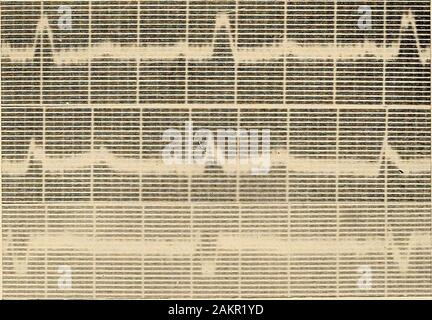 Clinical electrocardiography . Fig. 88.—Aberrant QRS complexes all ...