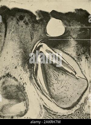 Principles and practice of operative dentistry . Inflammatoryvacuole ...