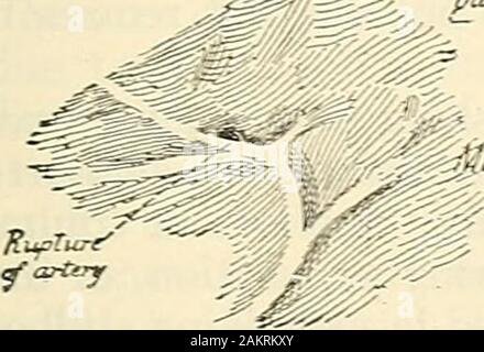 Modern surgery, general and operative . middle and outer thirds of ...