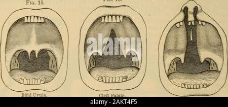 Syphilis ulcer in mouth Stock Photo - Alamy