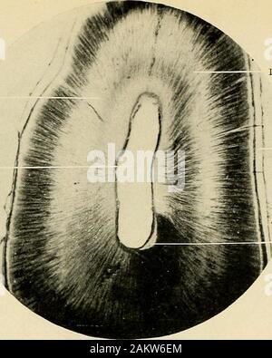 Principles and practice of operative dentistry . Dentinal tubuli ...