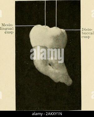 Principles and practice of operative dentistry . Mesio- buccal cusp ...
