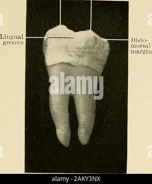 Principles and practice of operative dentistry . Mesio- buccal cusp ...
