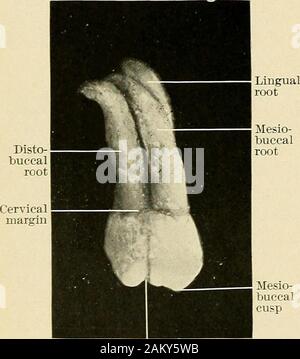 Principles and practice of operative dentistry . Mesio- buccal cusp ...