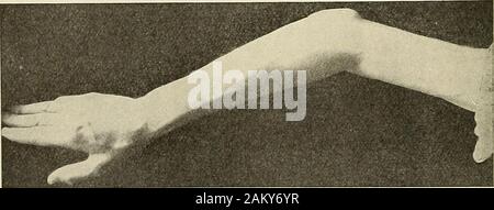 . Modern surgery, general and operative. the triceps, biceps, and ...