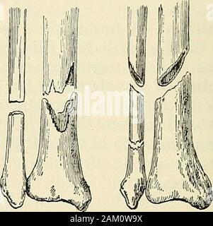 Transverse Fractures Fracture Types Stock Illustrations – 144