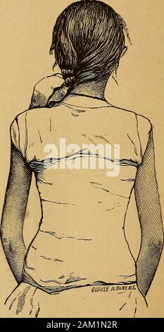 Spinal disease and spinal curvature : their treatment by suspension and ...