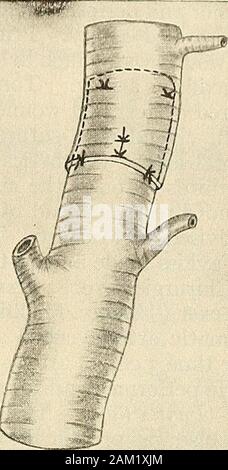 Modern surgery, general and operative . d by more pain, healing ...