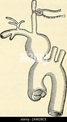 Modern surgery, general and operative . the sac and the ligature.Later ...