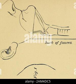 On stertor, apoplexy, and the management of the apoplectic state ...