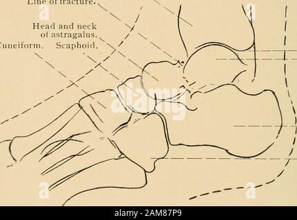 a large open wound is treated in a hospital with vacuum therapy Stock ...