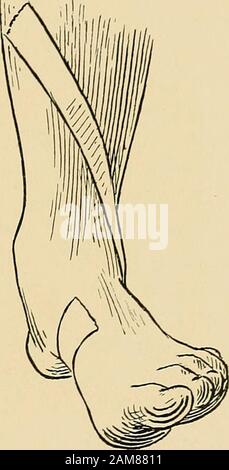The treatment of fractures . External malleolus. -V -—. Os calcis. i Os ...