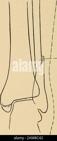 Lower leg fracture. X-ray of a fracture through the fibula (thinner ...