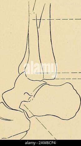Lower leg fracture. X-ray of a fracture through the fibula (thinner ...