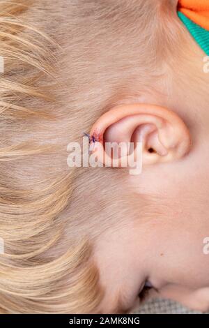 laceration in a child. A wound on the ear of young toddler. fresh ...