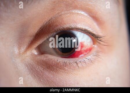 Hemorrhage in the eye of a woman. Bruising of the cornea. Macro Stock ...