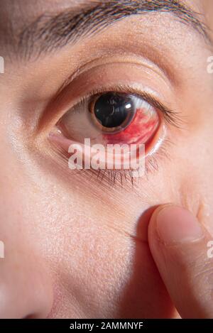 Hemorrhage in the eye of a woman. Bruising of the cornea. Macro Stock ...