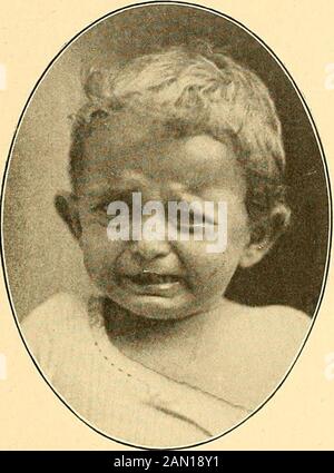 . Medical diseases of infancy and childhood. Congenital cretinism. The ...