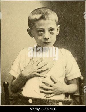 . Medical diseases of infancy and childhood. Congenital cretinism. The ...