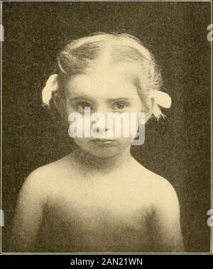 A child with congenital syphilis Stock Photo - Alamy